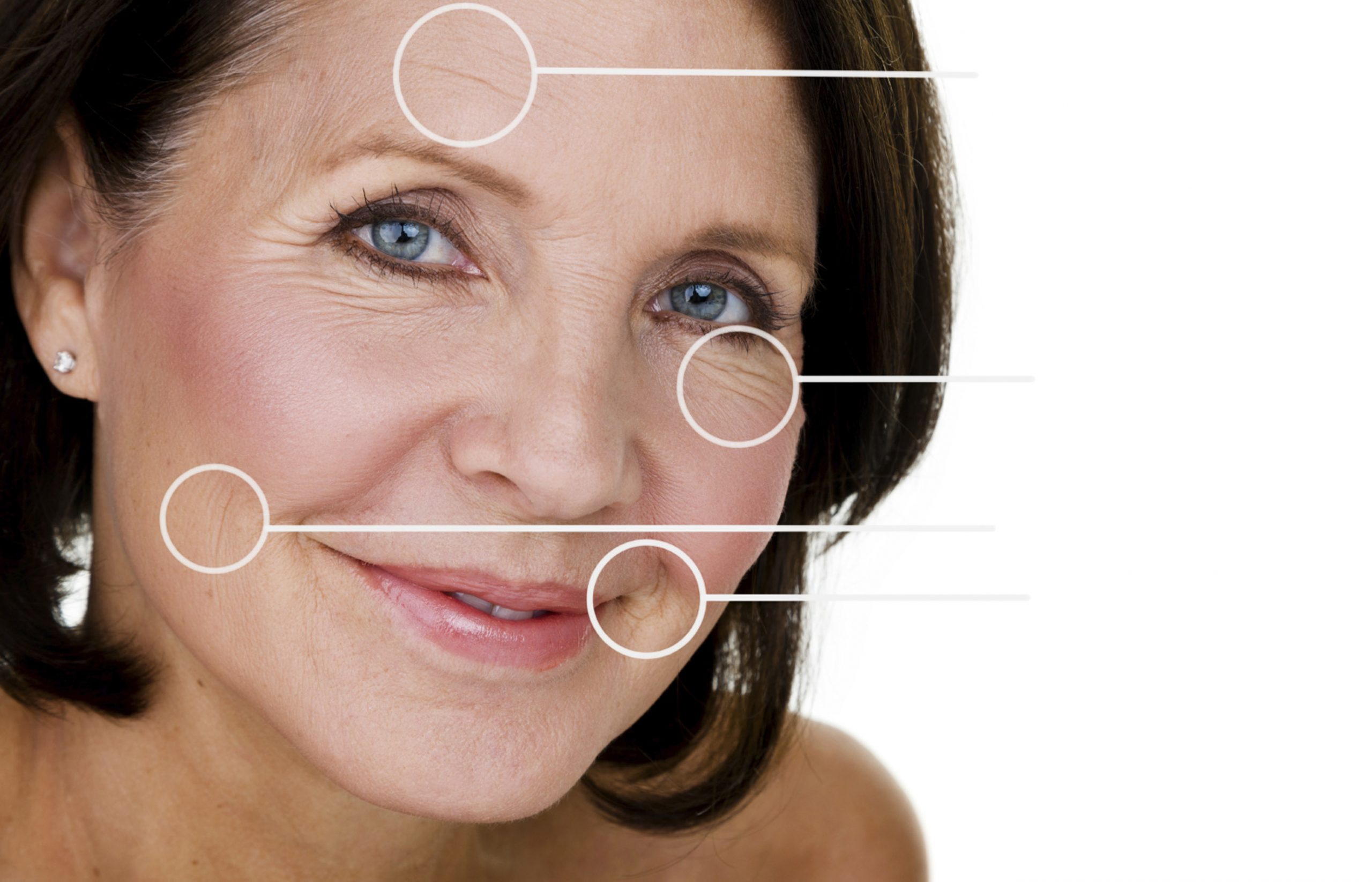 What Is A Skin Tag And How It Can Be Removed With The Lamprobe Radio ...