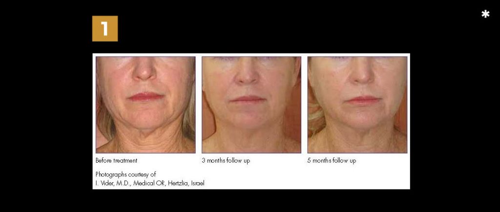 Intensif Fractional Micro Needling - Instant Laser Clinic