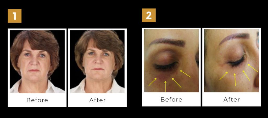 PRP - Instant Laser Clinic