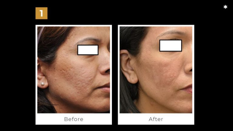 Subcision - Instant Laser Clinic