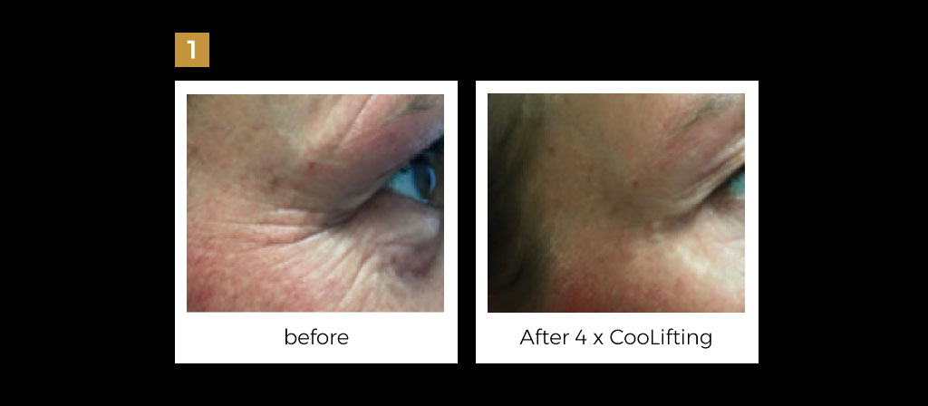 Cryo Lift - Instant Laser Clinic