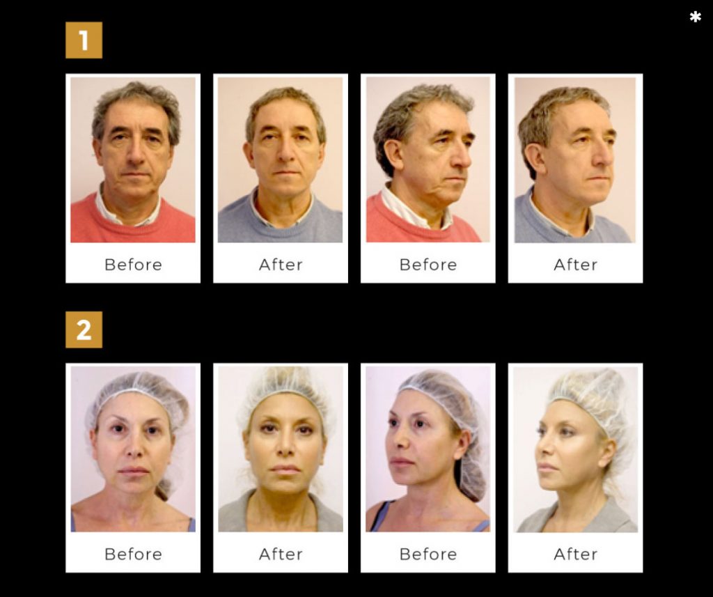 Silhouette Threads Face Lift - Instant Laser Clinic